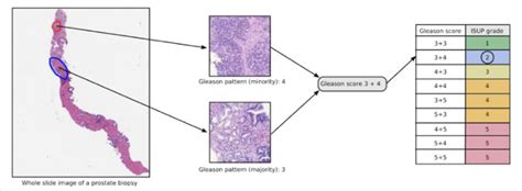 An Illustration Of The Gleason Grading Process For An Example Biopsy