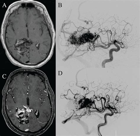 Onyx Embolization Prior To Stereotactic Radiosurgery For Brain
