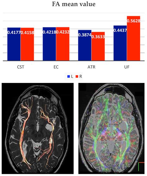 Diagnostics Free Full Text Giant Tumefactive Perivascular Space