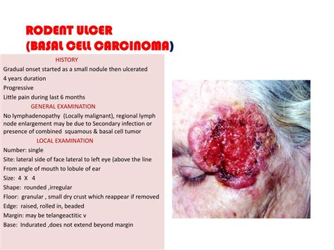 Ppt Skin Tumours Powerpoint Presentation Free Download Id 2160396