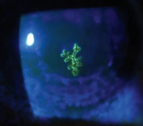 Herpes Simplex Dendritic Ulcer Fluorescein Staining Of The Cornea That