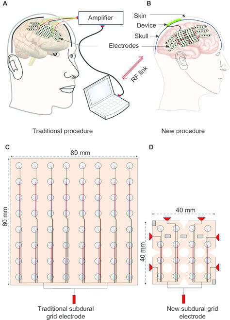 Schematic Representation Of Intracerebral Eeg Recording Systems And