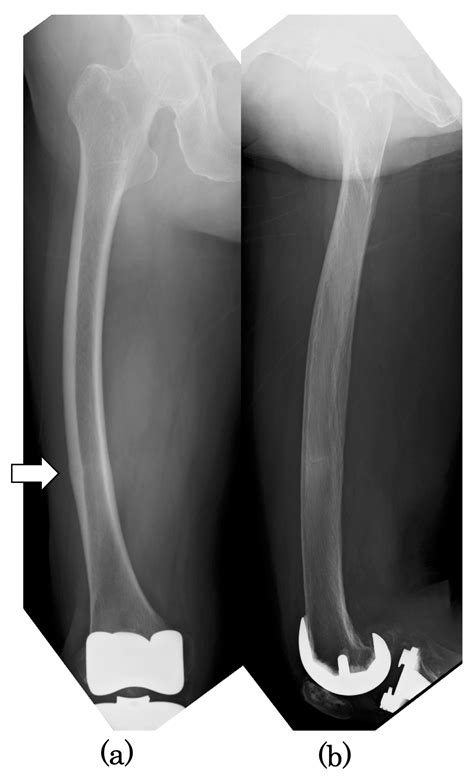 Incomplete Atypical Femoral Fracture With Severe Bowing Treated By