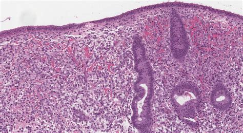 Proliferative Endometrium Ottawa Atlas Of Pathology