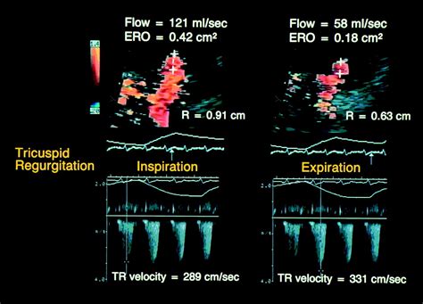 Pathophysiology Of Tricuspid Regurgitation Circulation