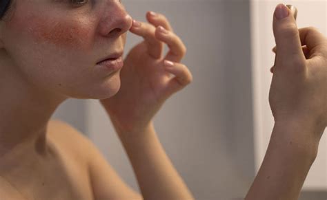 Understanding Rosacea Symptoms Triggers And Treatments