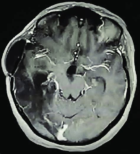 Postoperative Axial T1 Contrasted Magnetic Resonance Imaging