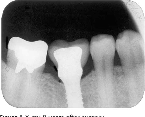 Figure 1 From Immediate Implant Placement In Fresh Mandibular Molar
