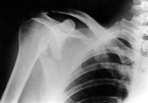 Arthroscopic Assisted Reduction And Percutaneous External Fixation Of A