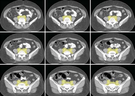 An Atlas Of Clinical Target Volume Ctv For Pelvic Lymph Nodes For