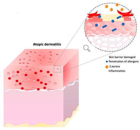 Atopic Dermatitis Ad Encyclopedia Mdpi