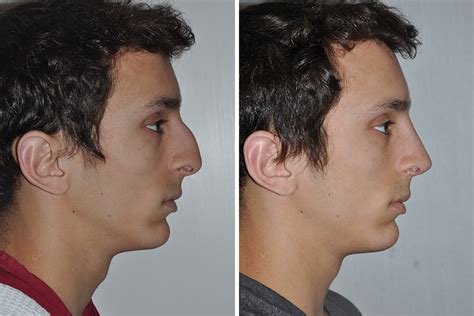 Nose Job Before And After Men