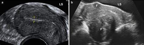 Ultrasound Evaluation Of Myometrium Obgyn Key