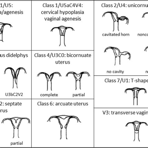 Classification Of Müllerian Duct Anomalies According To The Afs And