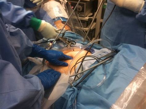 Hysterectomy Laparoscopic Hysterectomy