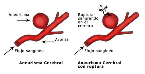Aneurisma Cerebral Síntomas Secuelas Causas Y Tratamiento