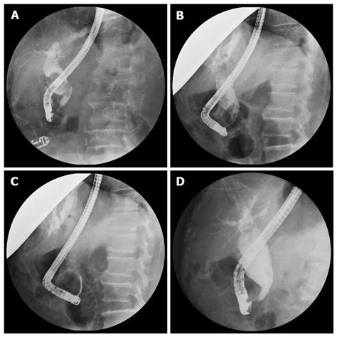 Endoscopic Retrograde Cholangiopancreatography Pictures