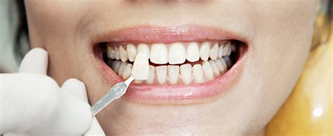 Installation Of Veneers Lumineers Dental Clinic S I Y Dental