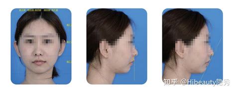 Hibeauty隐秀「牙列拥挤／隐形矫治器拔牙矫治」案例分享 知乎