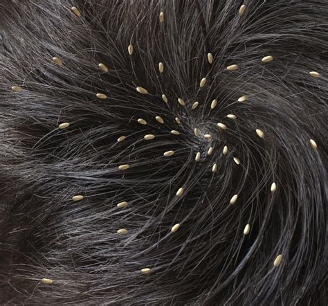 What Does Lice Look Like How To Get Rid Of Lice Head Louse Getting