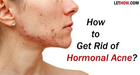 How To Get Rid Of Hormonal Acne