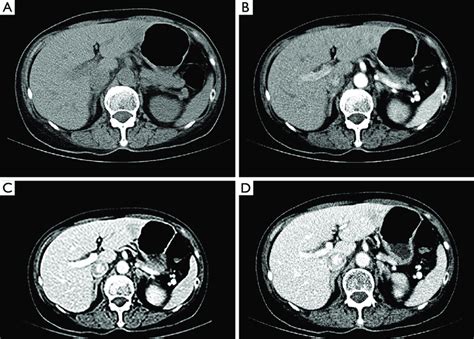 Contrast Enhanced Abdominal Computed Tomography Before Surgery A