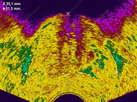 Ultrasound Showing Prostate Cancer Stock Image C027 2355 Science