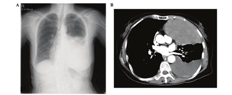 A Chest Roentgenography And B Computed Tomography Scans Showing A