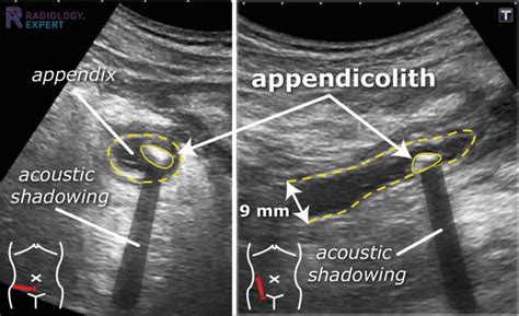 Abdominal Ultrasound