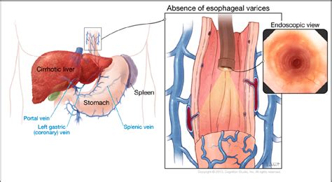 Figure 2 From Portal Hypertension Pre Primary And Primary Prophylaxis