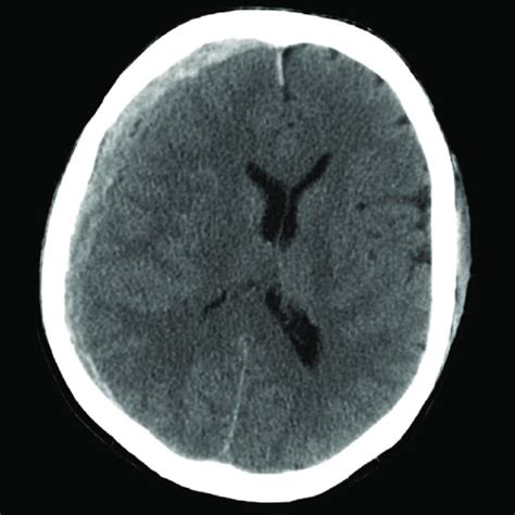 Axial Brain Computed Tomography Ct Scan Image Showing A Severe