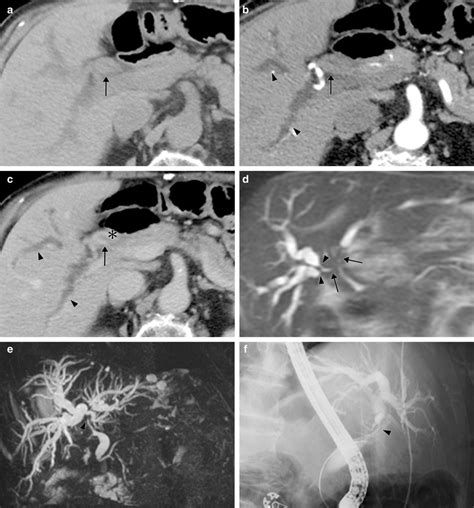Imaging Findings Of Igg4 Related Sclerosing Cholangitis In A