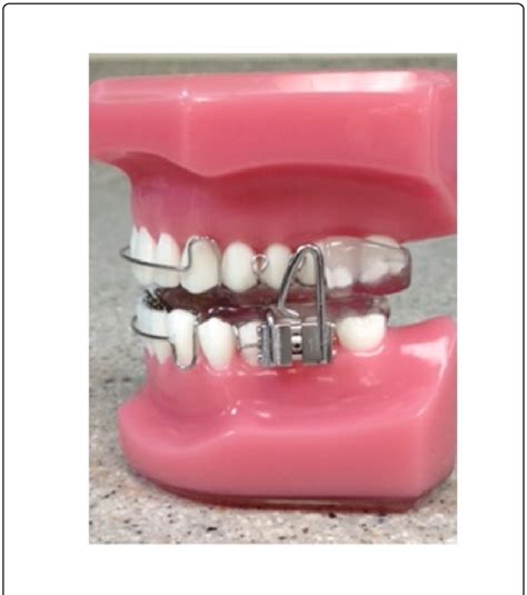 The Mandibular Repositioning Nighttime Appliance Mrna Appliance® That