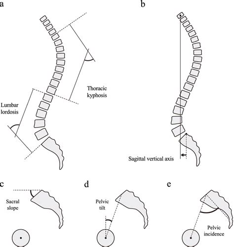 Measurement Of The Sagittal Spinopelvic Parameters A Lumbar Lordosis
