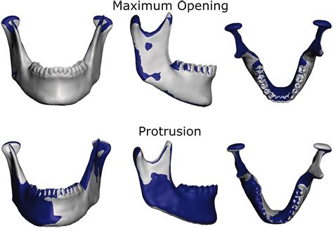 Frontiers A Dynamic Jaw Model With A Finite Element Temporomandibular