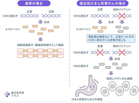 遺伝性びまん性胃がん 遺伝性疾患プラス