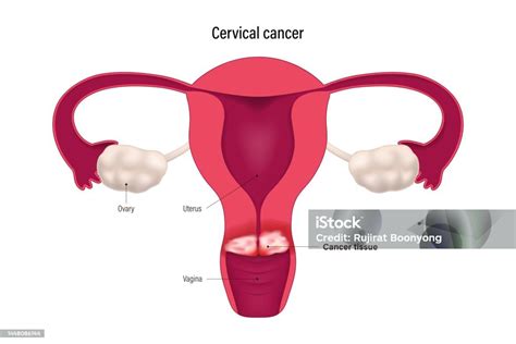 Cervical Cancer Cervix Carcinoma Female Reproductive System Disease