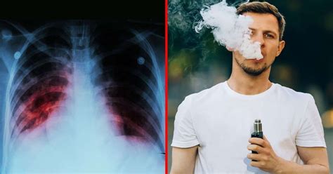 Warnings Against Vaping Arise With The Hike In Lung Diseases