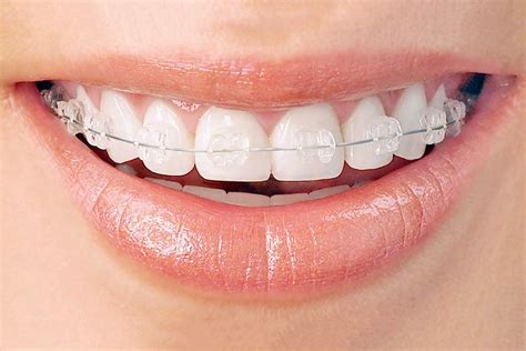 Average Cost For Braces In Australia At David Mahr Blog