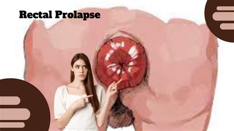 How To Treat Rectal Prolapse Without Surgery कैसे करें रेक्टल