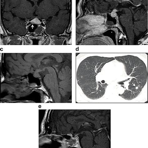 Magnetic Resonance Imaging Mri Showing Swelling Of The Pituitary Body