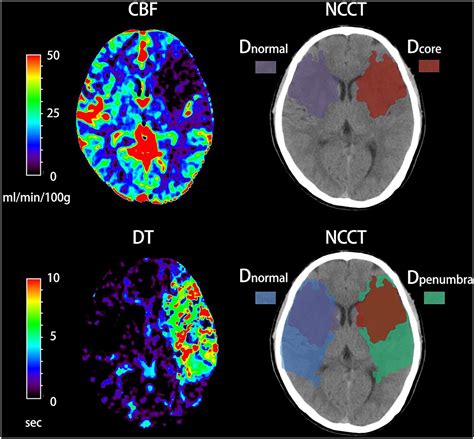 Frontiers Early Edema Within The Ischemic Core Is Time Dependent And