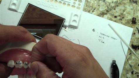 History Of Orthodontic Brackets At Michael Conroy Blog