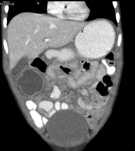 Abdominal Computerized Tomography Showing Thick Walled Cystic Structure