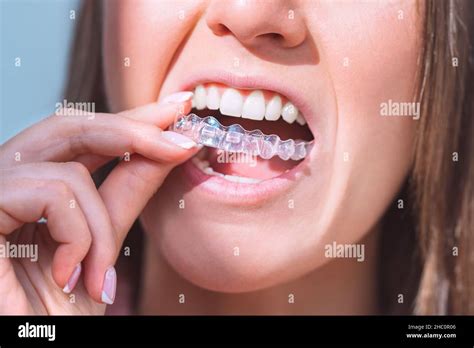 Woman With Perfect Smile Inserting Invisible Dental Aligners For Dental