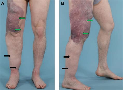 Ktw Syndrome Illustrated Explained Using A Medical 44 Off
