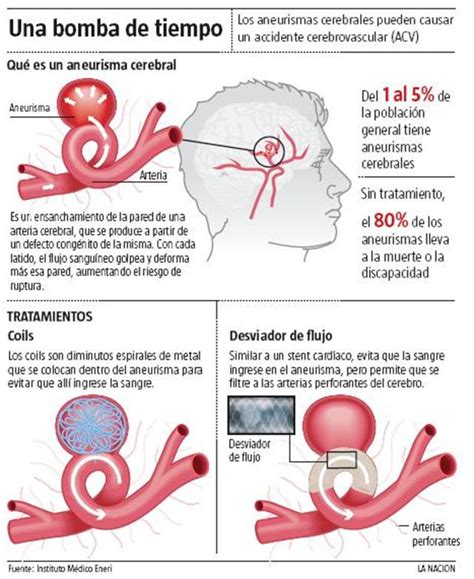 Aneurisma Cerebral Síntomas Secuelas Causas Y Tratamiento