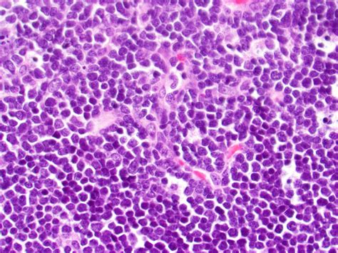 Acute Lymphoblastic Leukemia Bone Marrow Biopsy