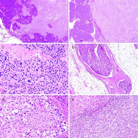 Histologic Features H And E Stain Of Spns A Infiltrative And B