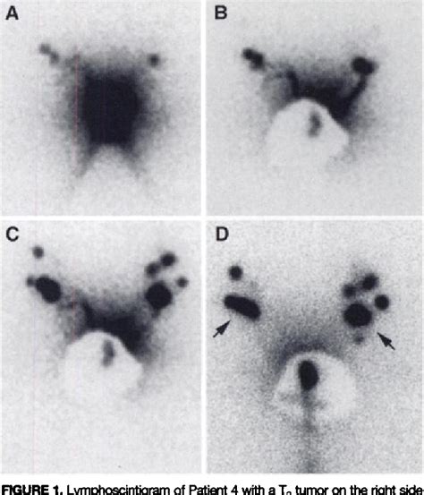 Figure 1 From Sentinel Lymph Node Identification With Technetium 99m